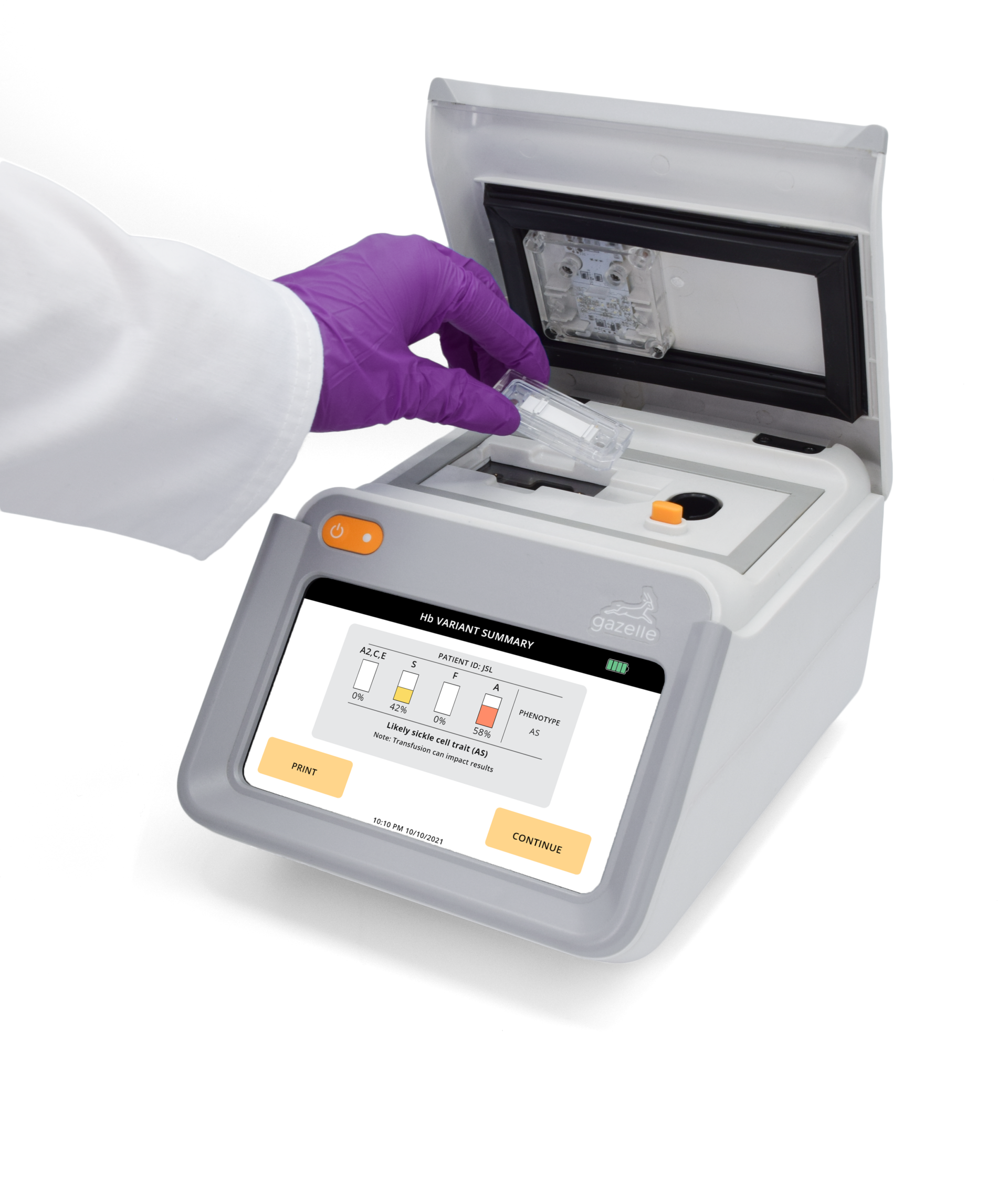 Study of First Affordable and Rapid Test for Beta Thalassemia Performs ...